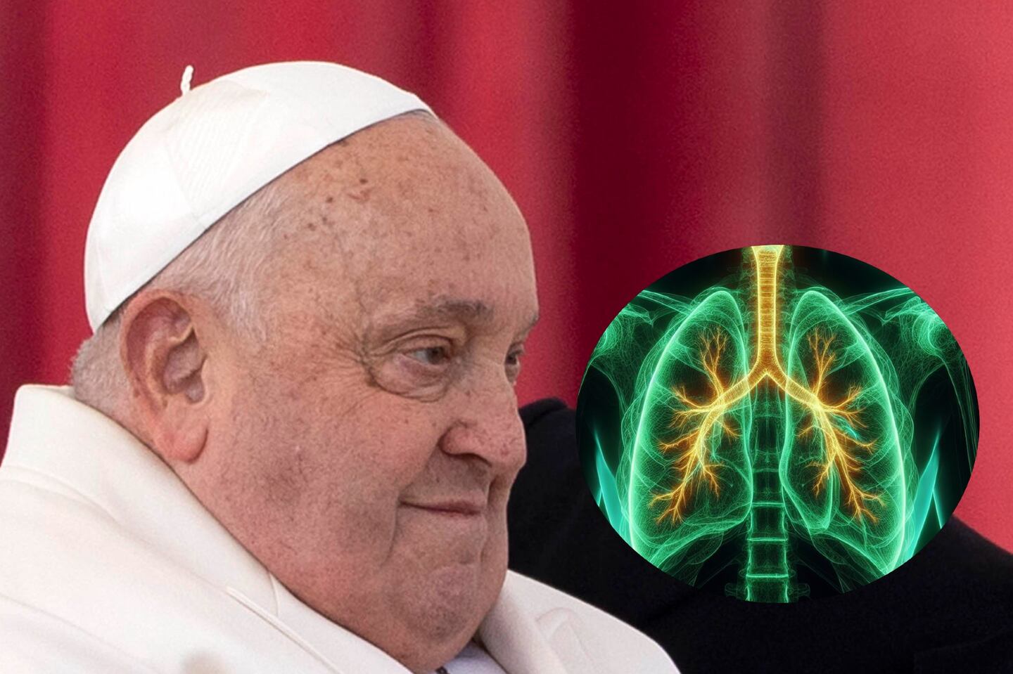 ¿Qué es la neumonía bilateral? Síntomas de la enfermedad que tiene al Papa Francisco ...